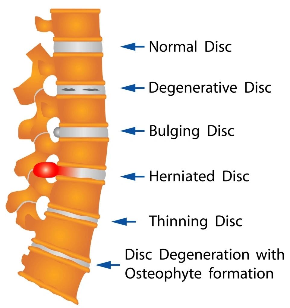 Common Soft Tissue Injuries: The Bulging Disc, vs Herniated - Redmond ...